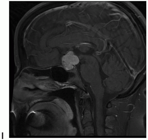 Tumors of the Sellar Region | Radiology Key