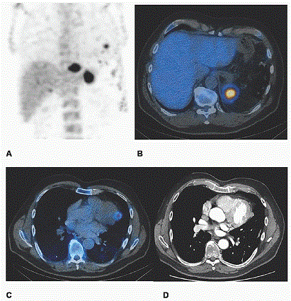 Gastrointestinal & Hepatobiliary Scintigraphy | Radiology Key