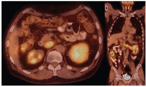 Renal Scintigraphy | Radiology Key