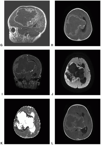 Ependymal Tumors | Radiology Key