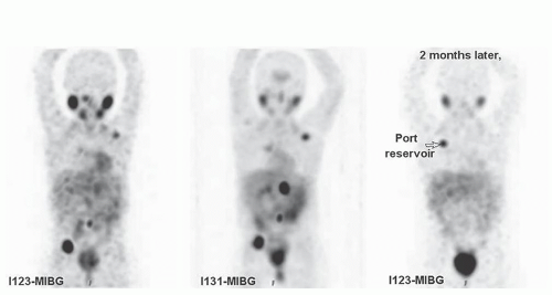Radio-Theranostics | Radiology Key