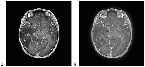 Central Nervous System Tumor Mimics | Radiology Key