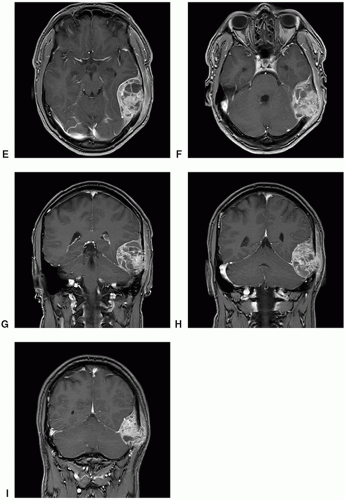 Mesenchymal Tumors | Radiology Key