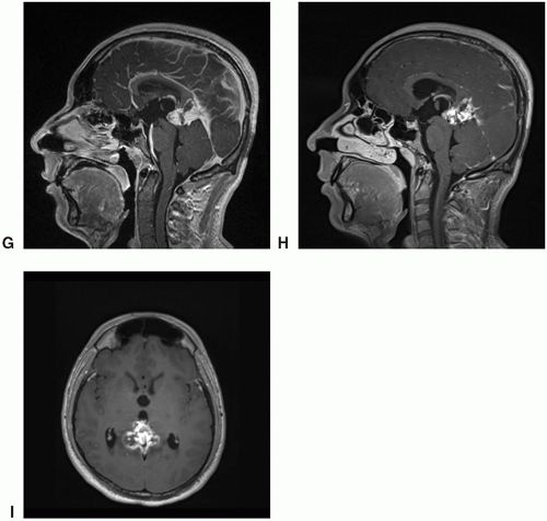 Germ Cell Tumors | Radiology Key