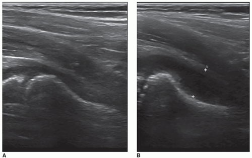 Your Hip Joints Pictures