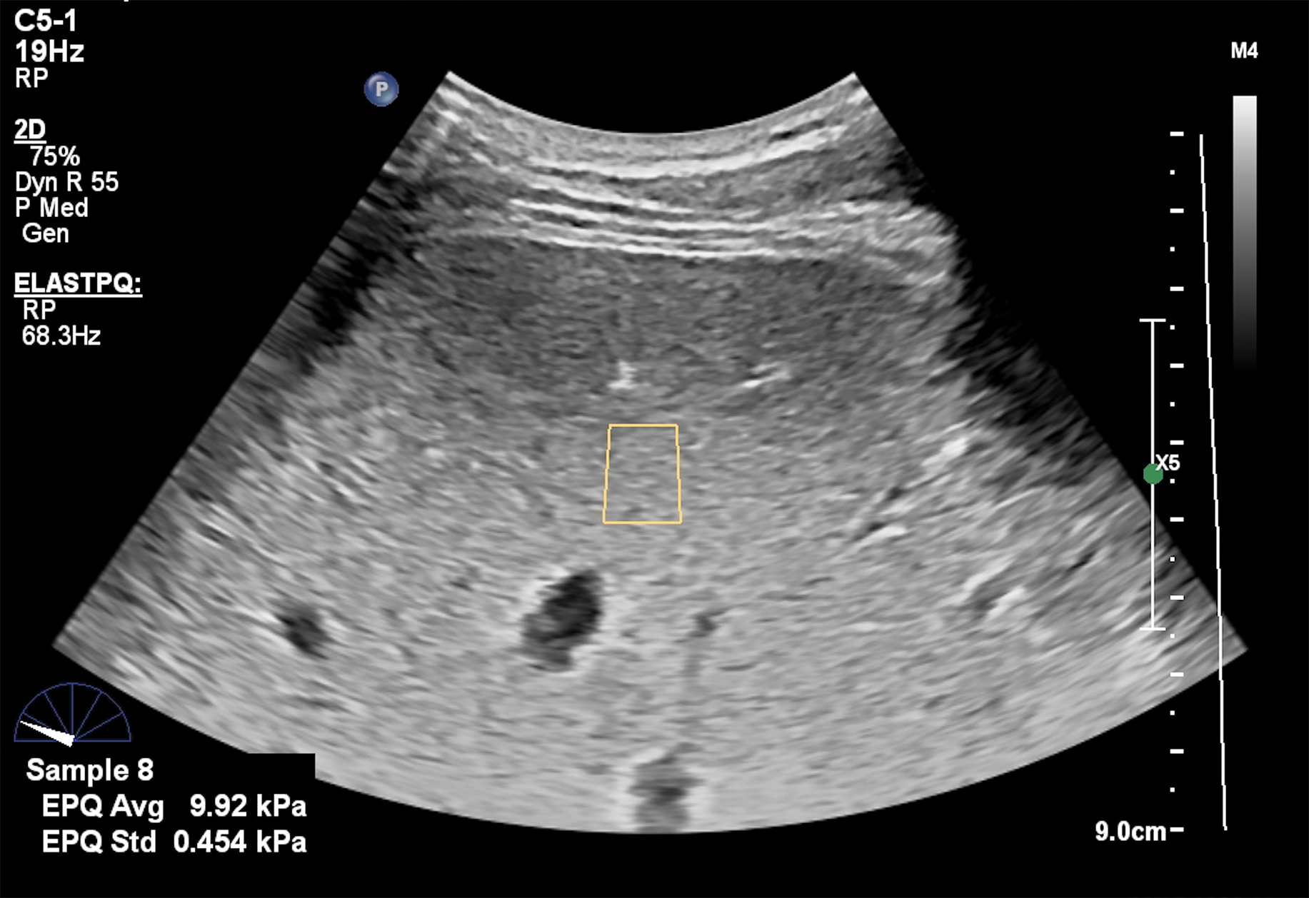 Tips and tricks for liver stiffness evaluation | Radiology Key