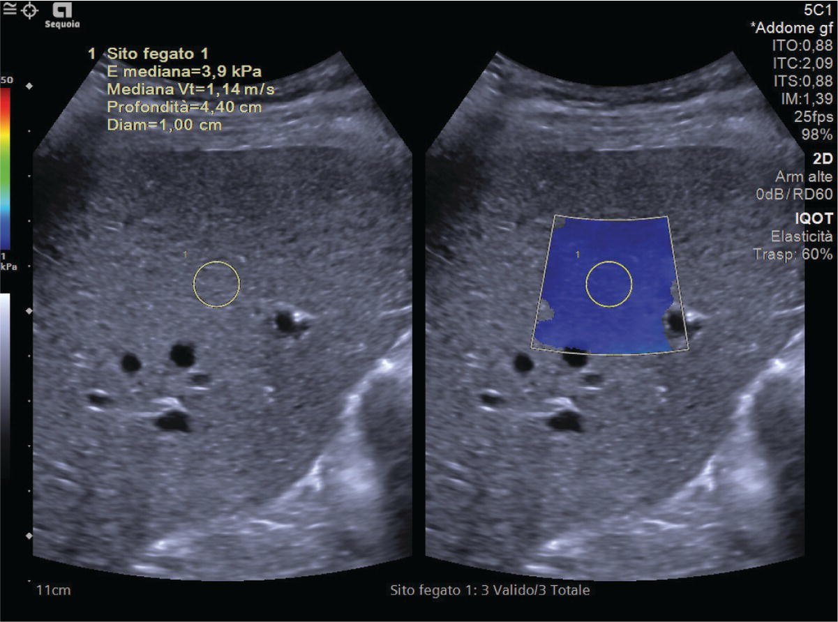 Shear Wave Elastography for Liver Disease: Part 1 | Radiology Key