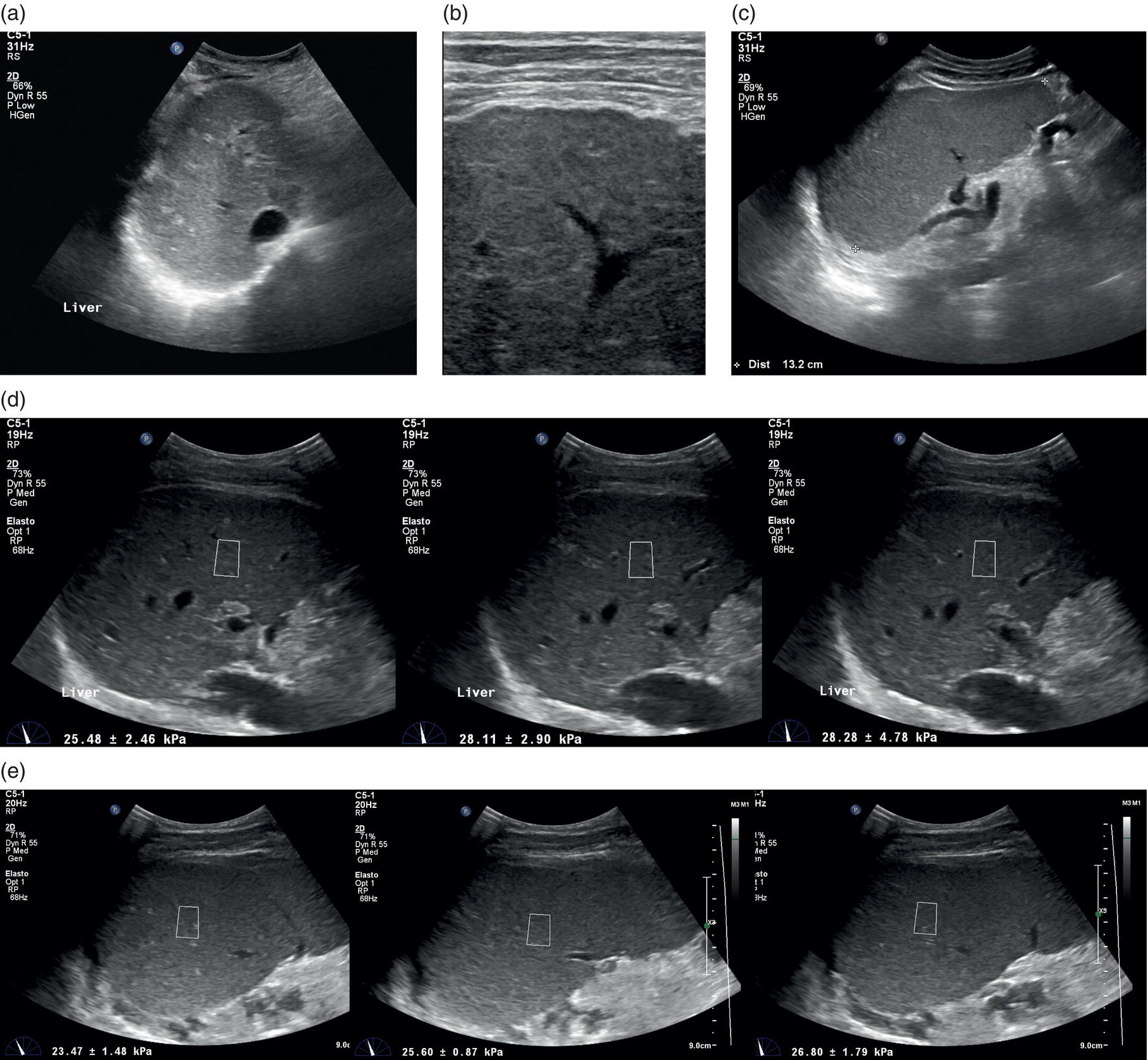 Shear Wave Elastography for Liver Disease: Part 2 | Radiology Key