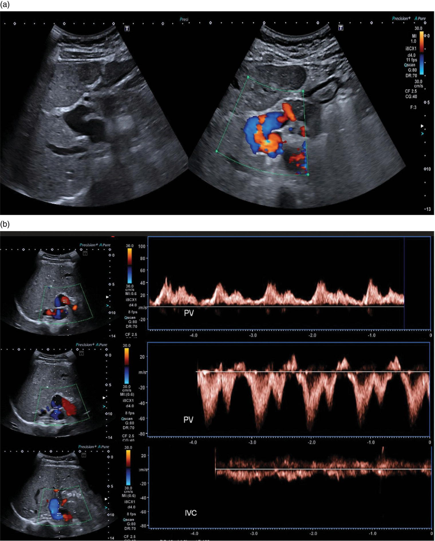 Ultrasound in Vascular Liver Diseases | Radiology Key