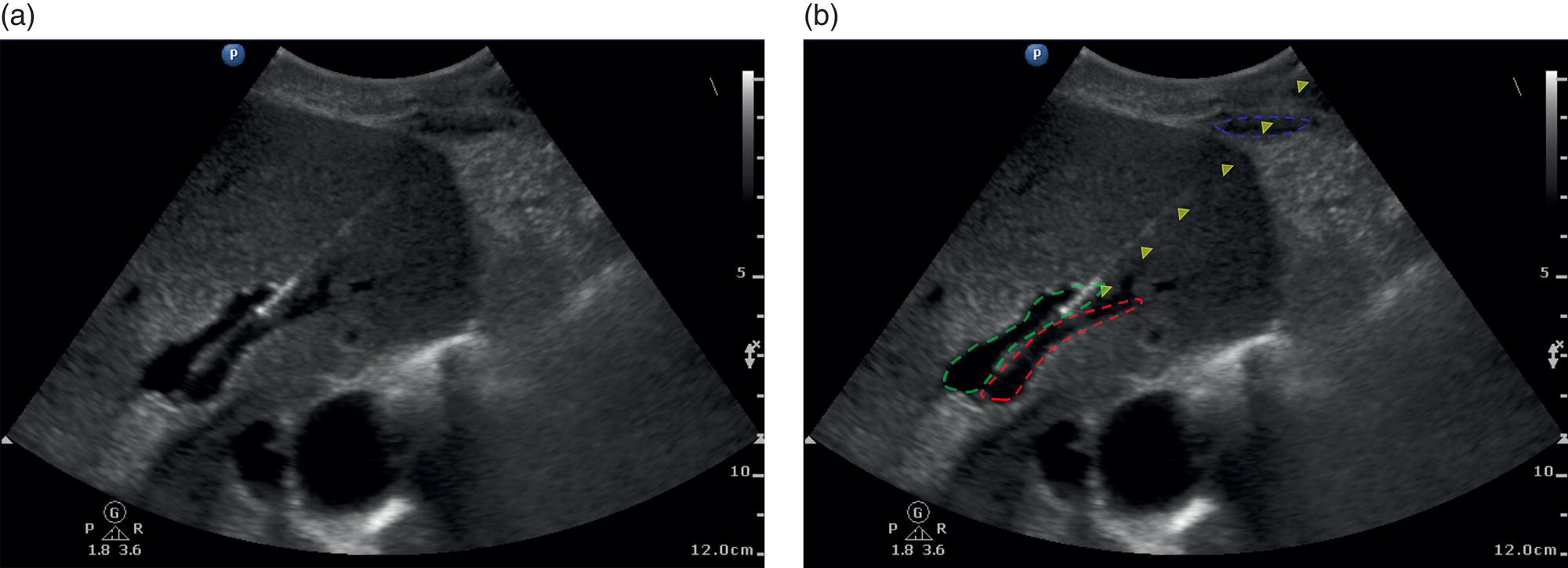 Ultrasound in Hepatobiliary Intervention | Radiology Key