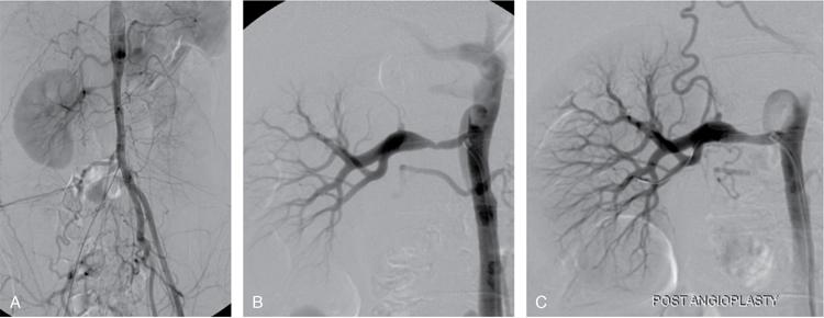 Vasculitis | Radiology Key
