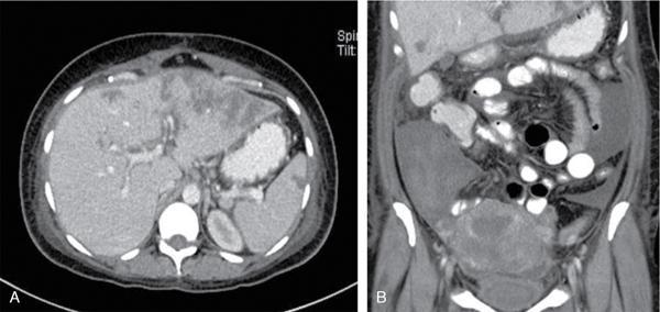 Bleeding diathesis | Radiology Key