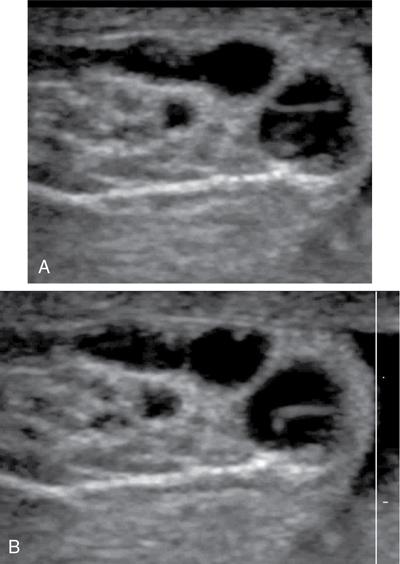 Systemic manifestations of infection/infestation | Radiology Key
