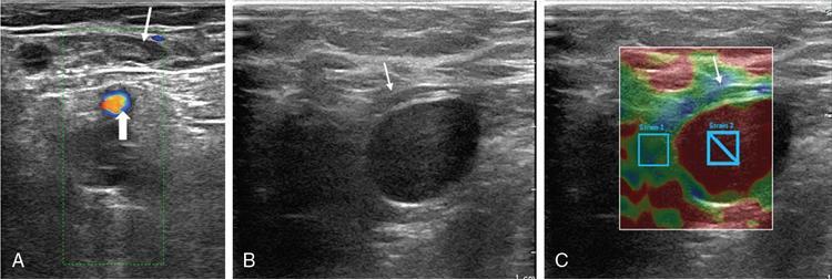 Radiological imaging of skin and subcutaneous disorders | Radiology Key