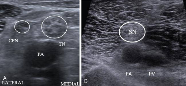 Image guided nerve blocks and sympathectomies | Radiology Key
