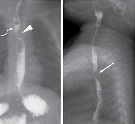 Paediatric neck | Radiology Key