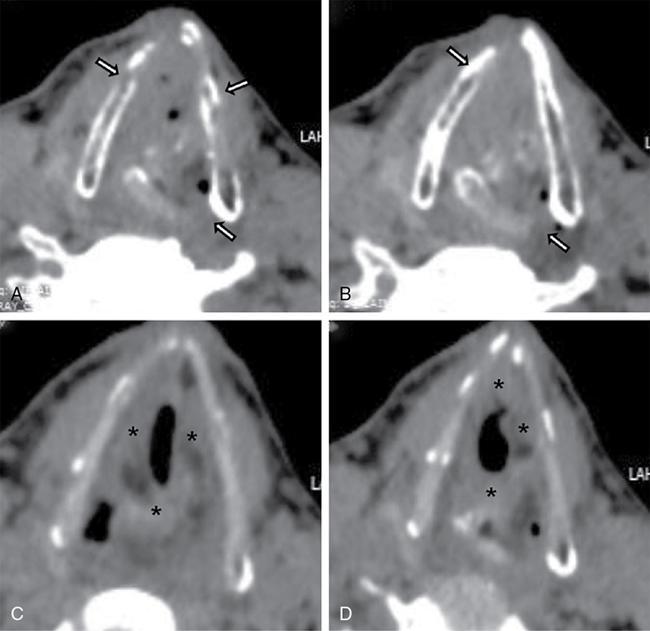Larynx and hypopharynx | Radiology Key