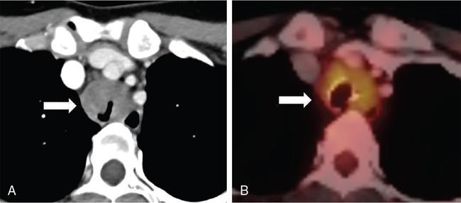 Visceral space (cervical oesophagus and trachea) | Radiology Key