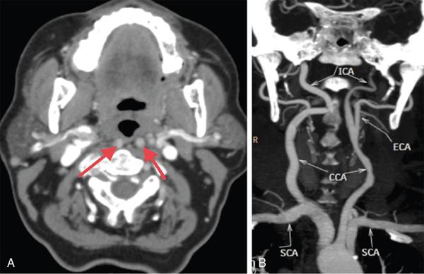 Retropharyngeal space | Radiology Key