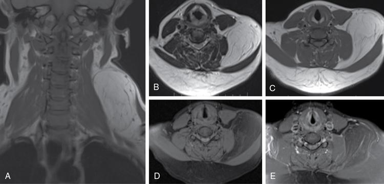 Posterior cervical space | Radiology Key