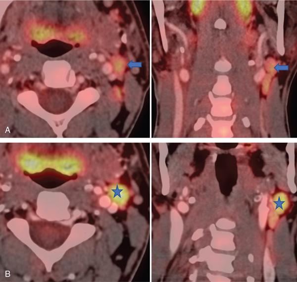 Imaging in head and neck lymphnodes | Radiology Key
