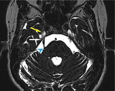 Imaging of middle cranial fossa and fifth cranial nerve (trigeminal ...