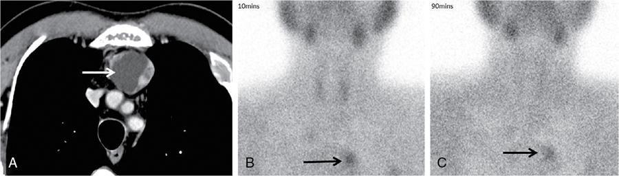 Imaging of parathyroid glands | Radiology Key