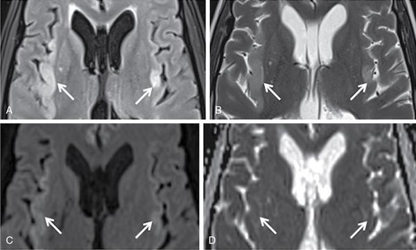 Posttreatment imaging in head and neck cancer | Radiology Key