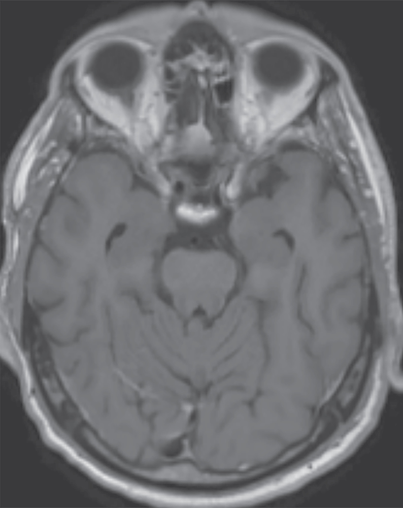 Planum sphenoidale/orbital roof meningioma – delayed postoperative ...