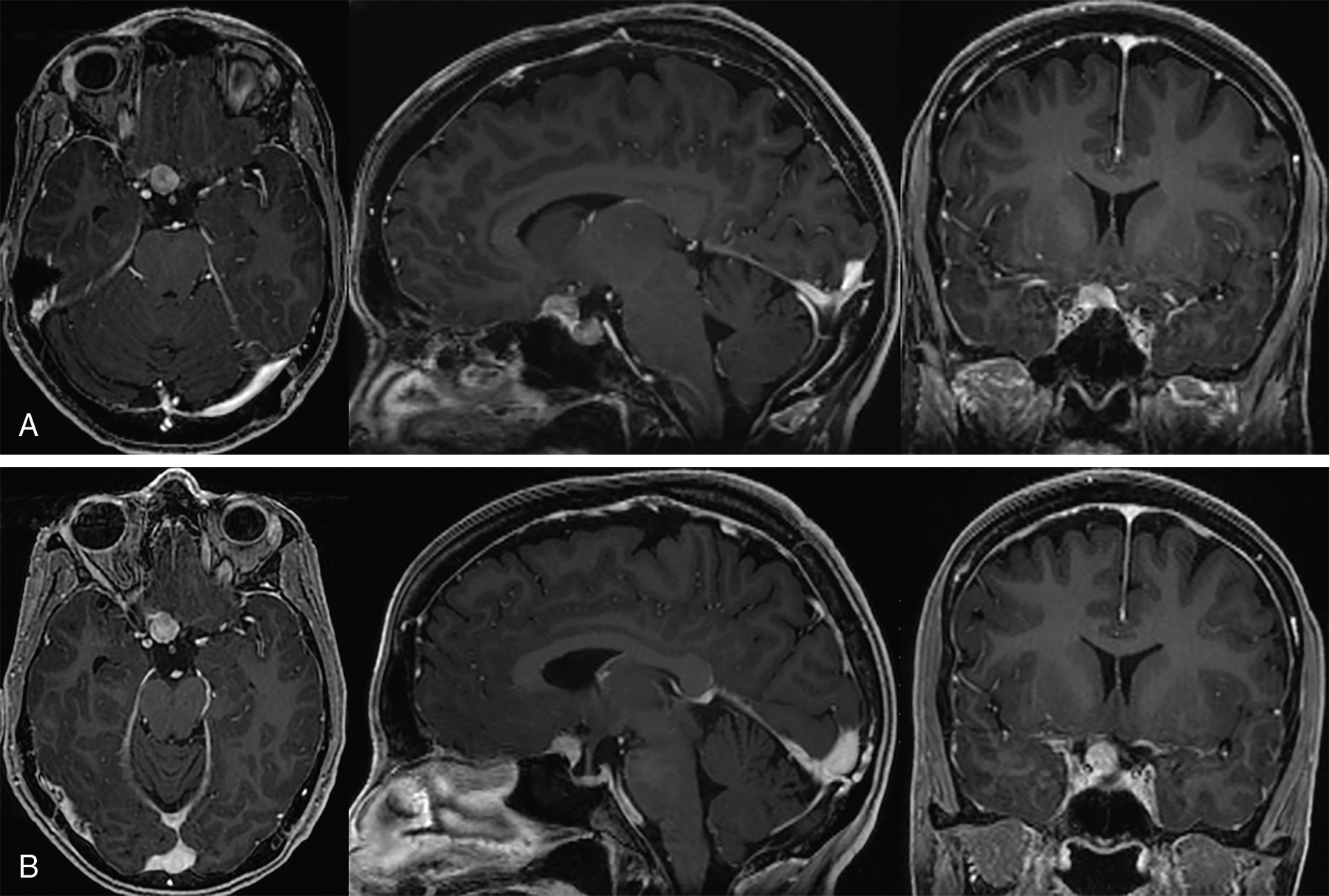 Tuberculum sella meningioma – upfront radiosurgery | Radiology Key