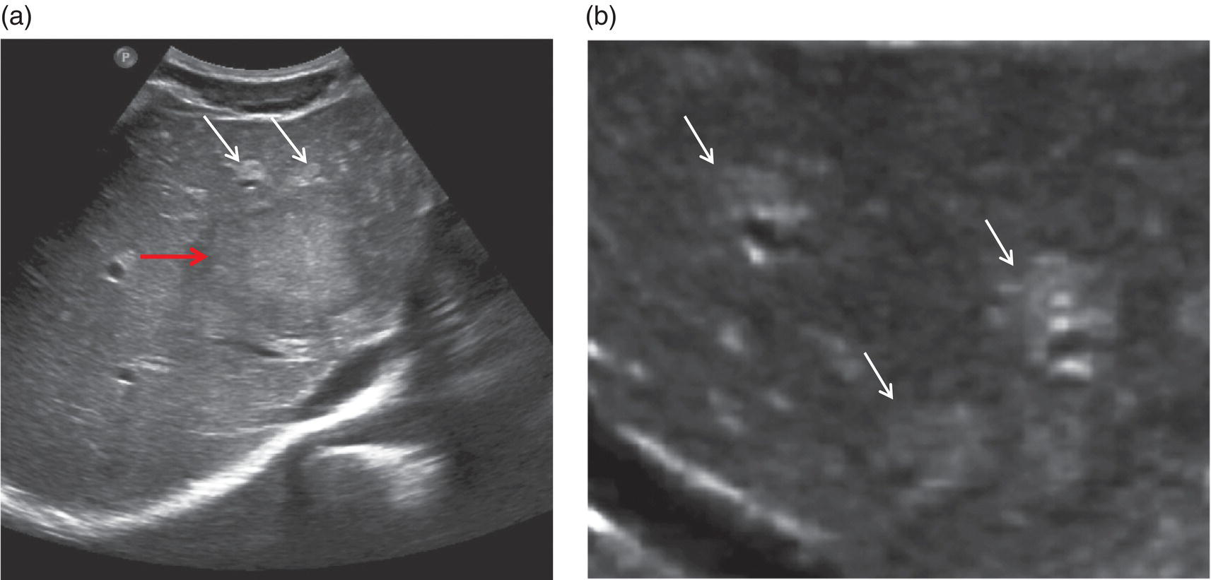 Ultrasound of the Biliary System | Radiology Key