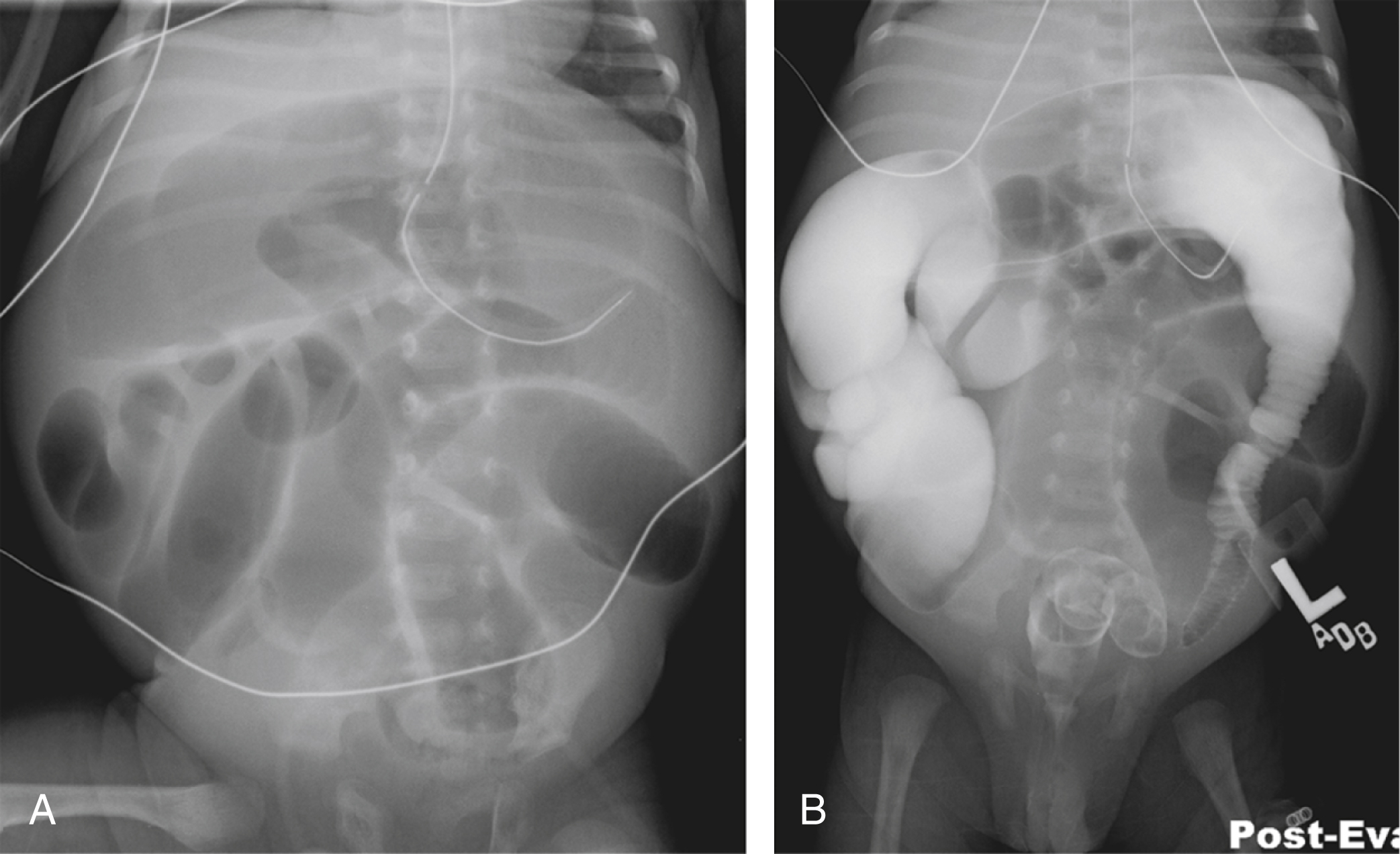 Pediatric Abdominal Pain | Radiology Key