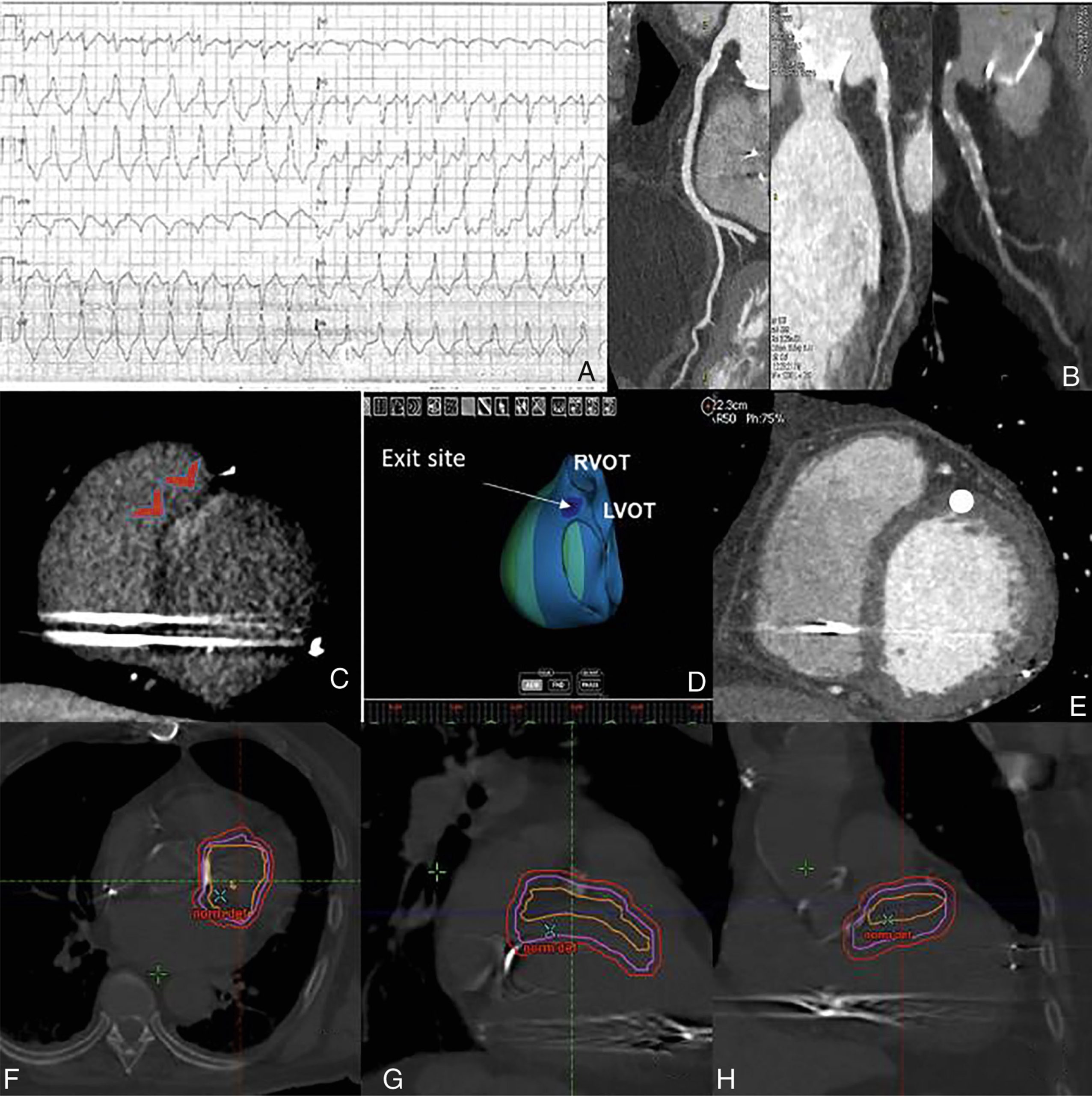 Disorders of the Cardiac Rhythm | Radiology Key