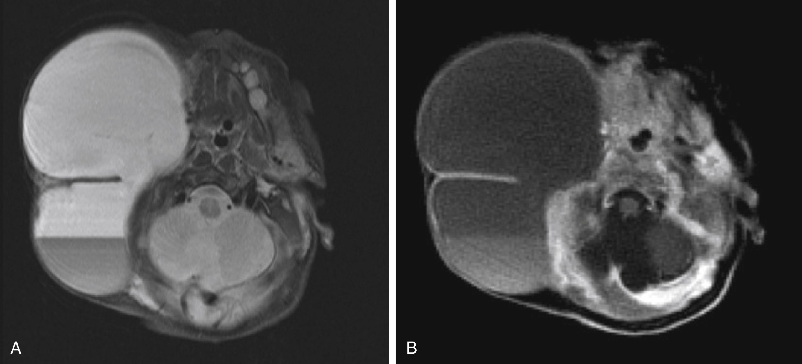Approach to Pediatric Soft Tissue Masses | Radiology Key