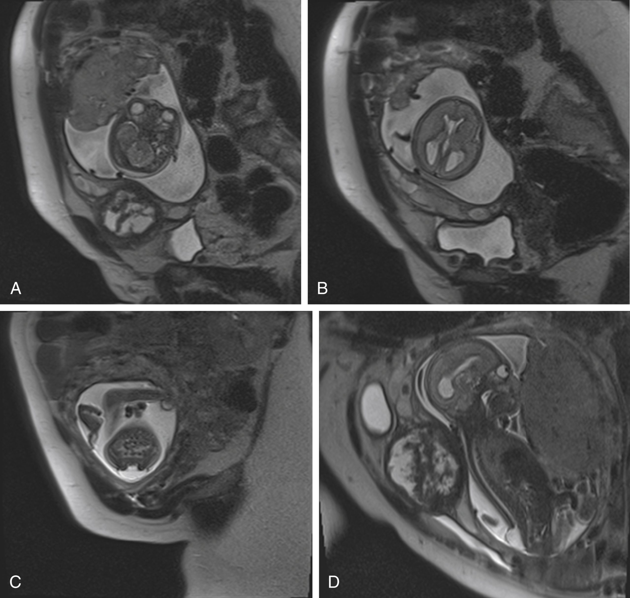 Fetal CNS MRI | Radiology Key
