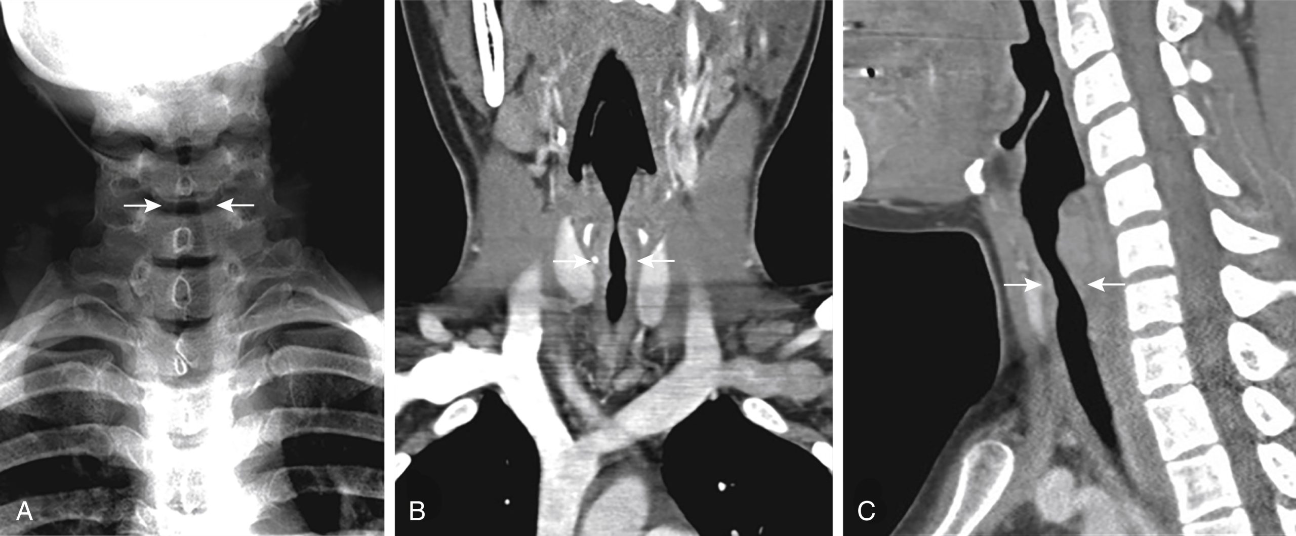 Approach to Lateral Neck Radiographs | Radiology Key