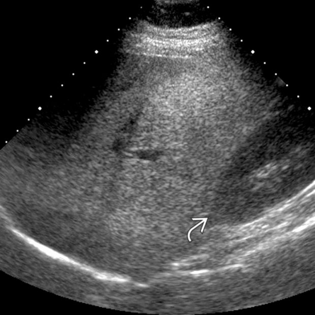 Biloma | Radiology Key