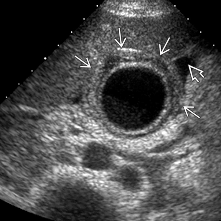 Sinusoidal Obstruction Syndrome (Venoocclusive Disease) | Radiology Key