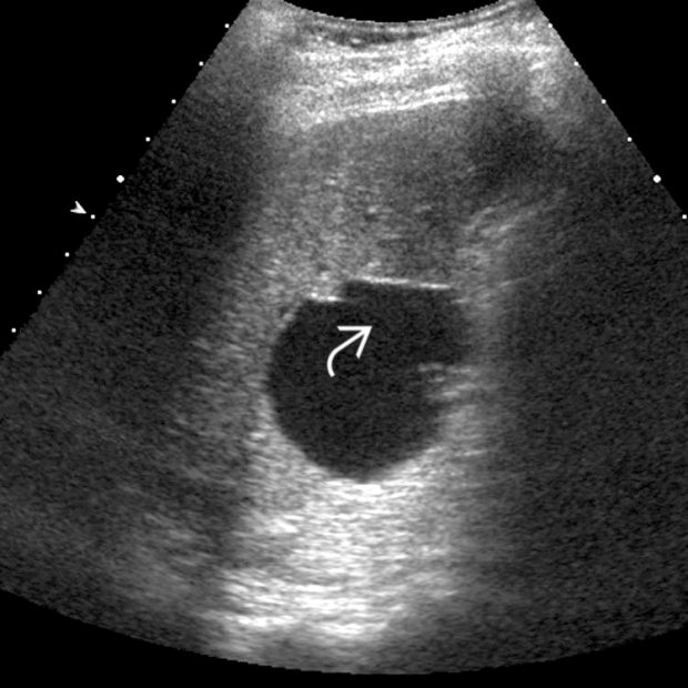 Biloma | Radiology Key