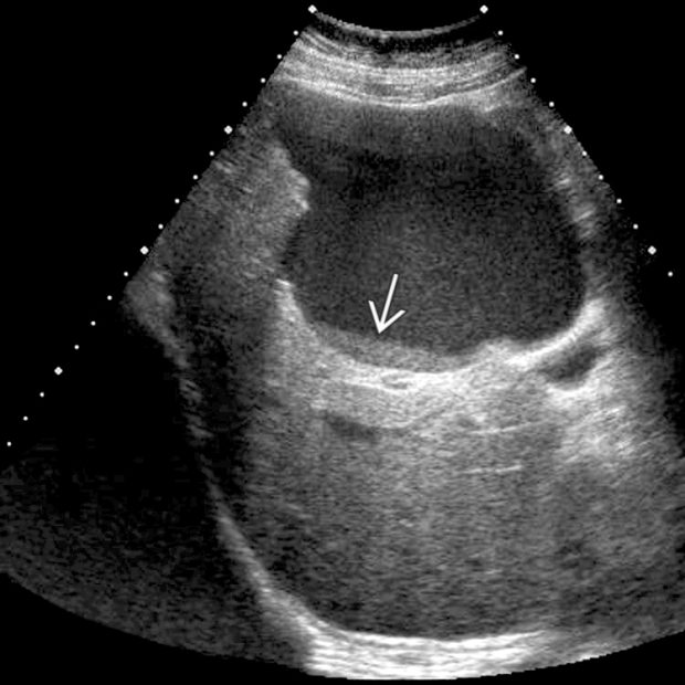 Biloma | Radiology Key