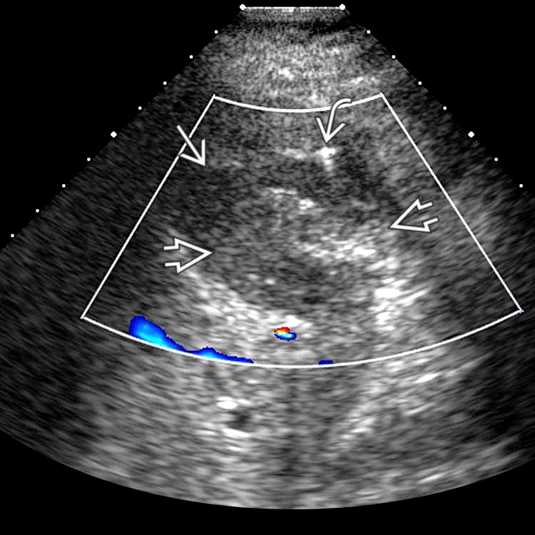 Biloma | Radiology Key