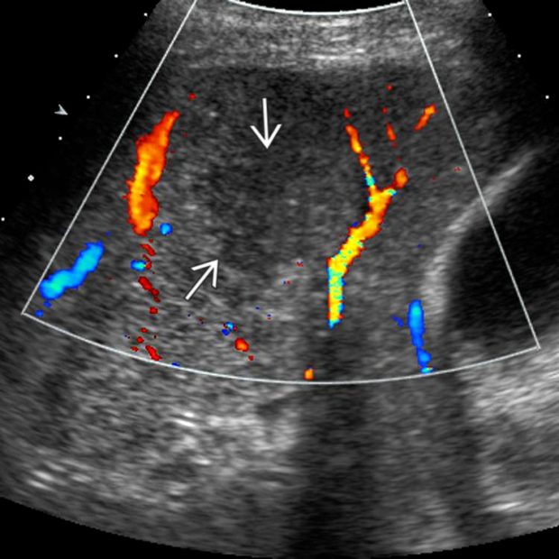Peribiliary Cyst | Radiology Key