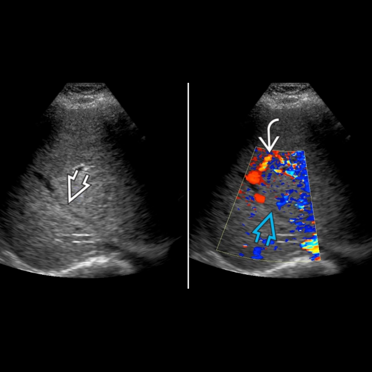Budd Chiari Syndrome Ultrasound