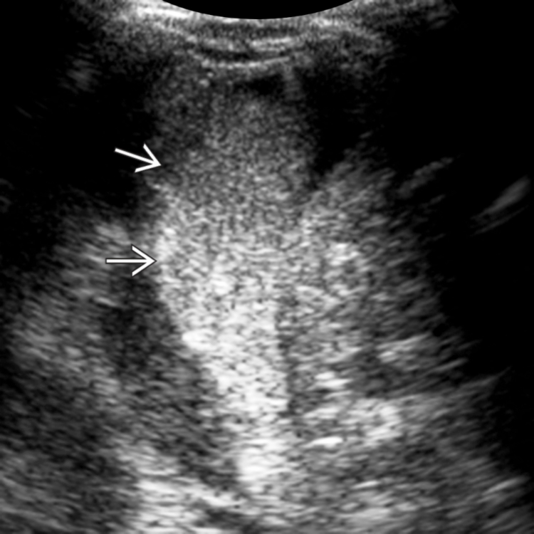 Echogenic Bile | Radiology Key