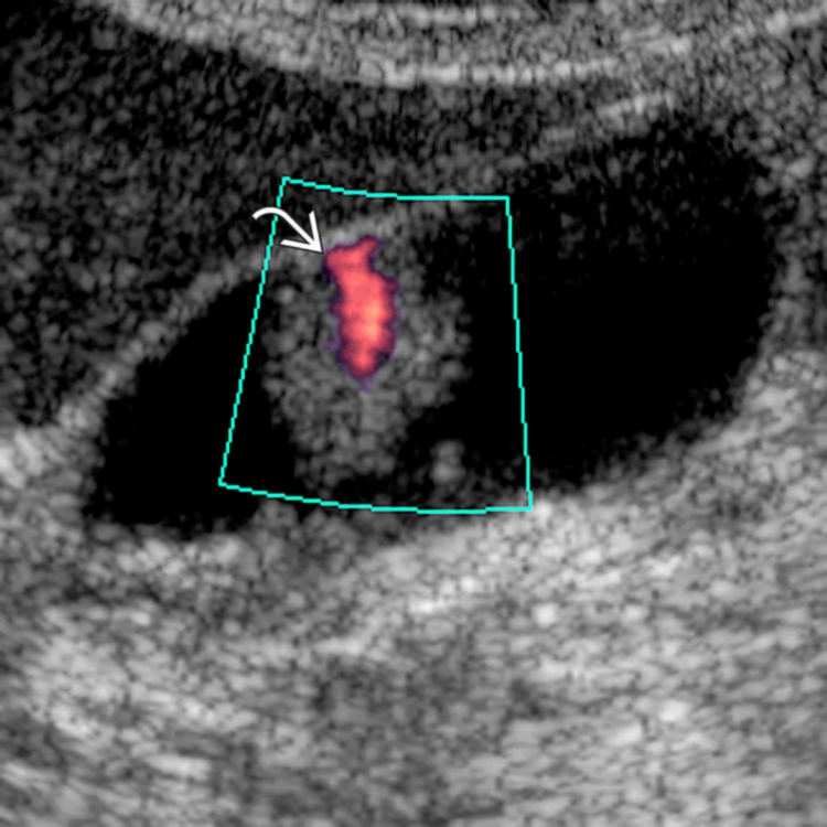 Gallbladder Polyp | Radiology Key