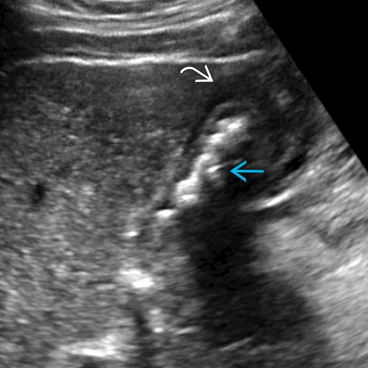 Acute Calculous Cholecystitis | Radiology Key