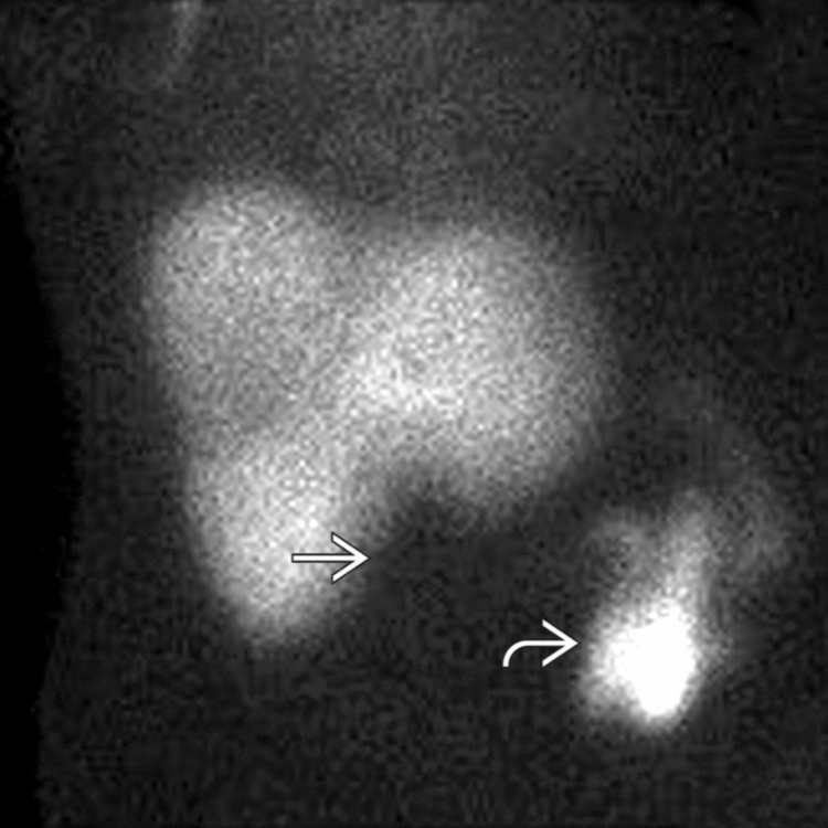 Acute Acalculous Cholecystitis | Radiology Key