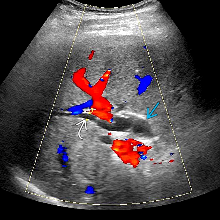 Biliary Ductal Dilatation | Radiology Key