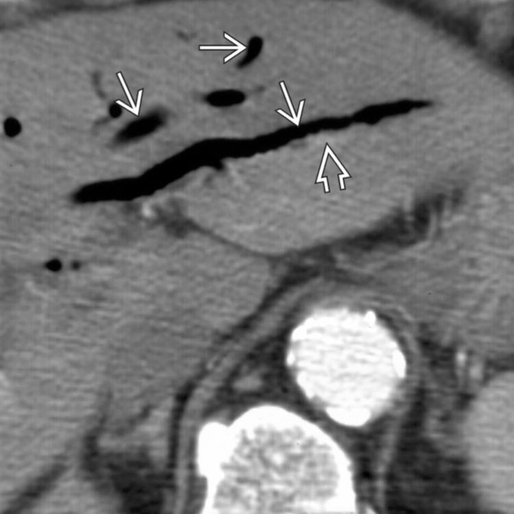 Biliary Ductal Gas | Radiology Key
