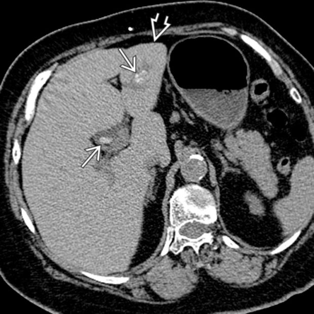 Renal Abscess | Radiology Key